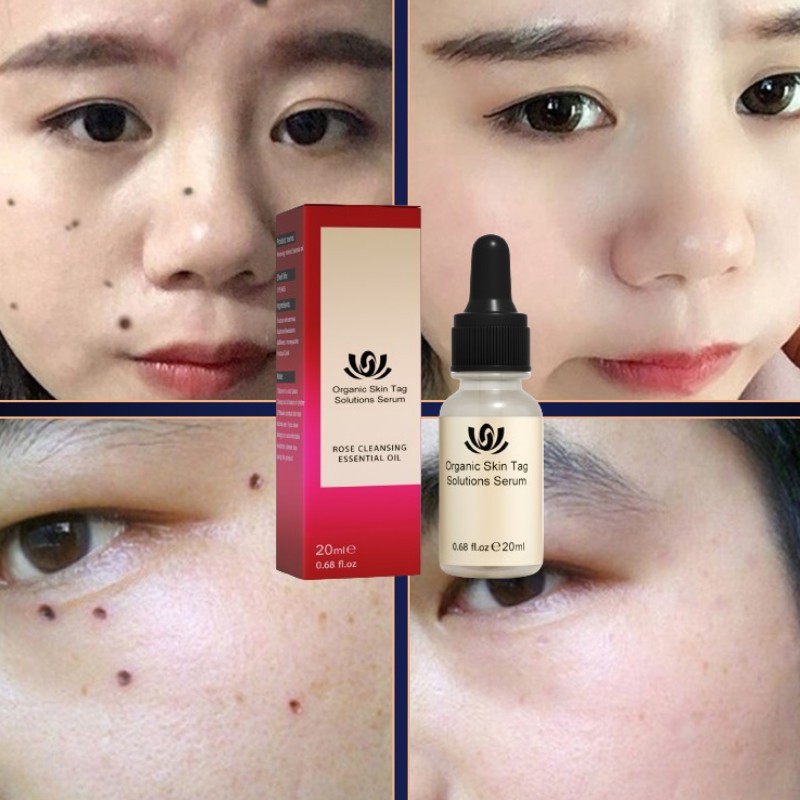 Jual Penghilang Tahi Lalat Penghilang Kutil Skin Tag Remover Serum ...