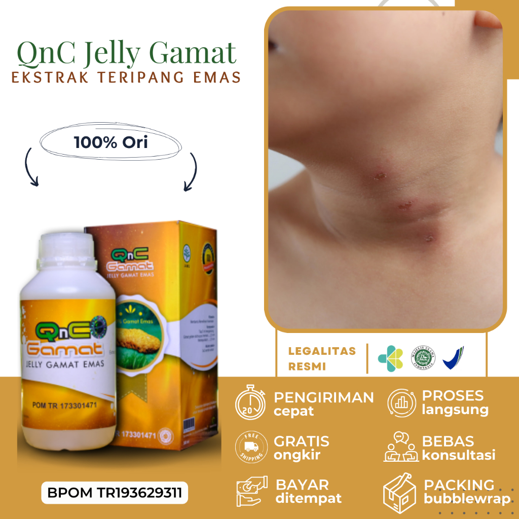 Jual Obat Kelenjar Getah Bening Oles Benjolan Bengkak Di Tubuh ...