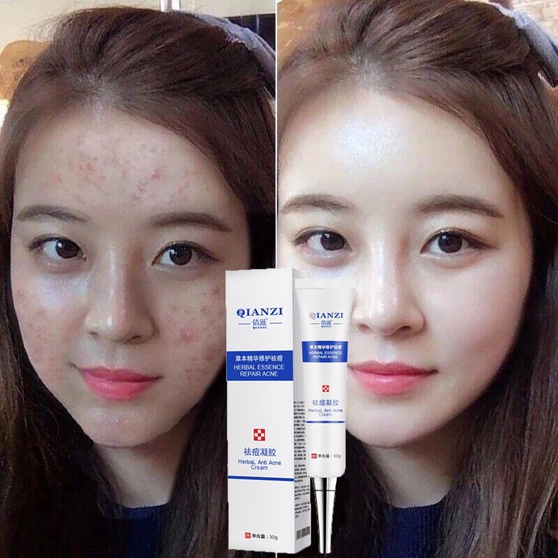 Jual Acne Cream krim jerawat Bekas jerawat Acne Cream 30g Antibacterial ...