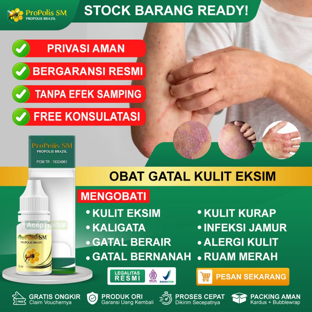 Jual Obat Gatal Kulit Eksim Kaligata Gatal Berair Gatal Bernanah Kulit ...