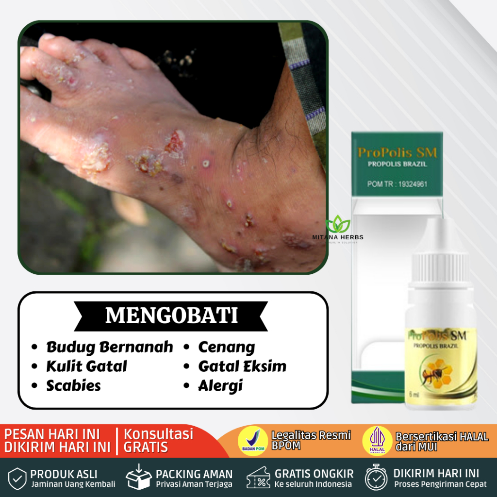 Jual Obat Budug Kulit Gatal Cenang Bernanah Borok Di Kaki Gudik Eksim ...