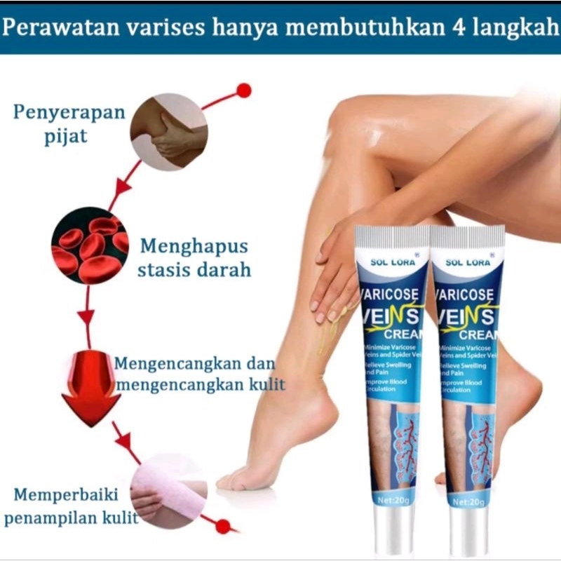 Jual Varises Cream Premium Sol Lora Herbal. Salep Varicose Vein Ampuh ...