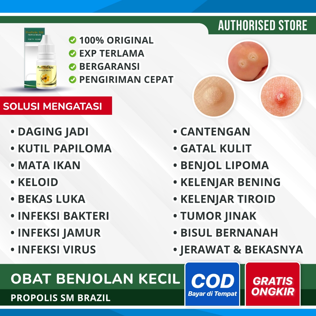 Jual Obat Tetes Mata Ikan Telapak Kaki Foot Corn Kapalan Kutil Propolis ...