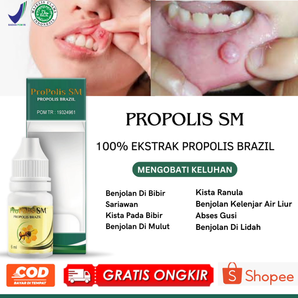 Jual Obat Sariawan Kista Pada Bibir Benjolan Di Mulut Abses Gusi Anak ...