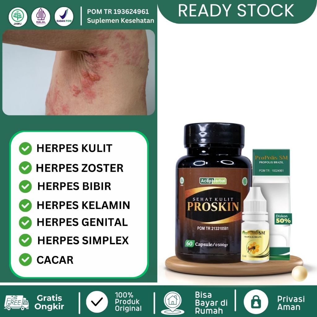 Jual Obat Herpes Kulit, Obat Herpes Zoster, Obat Herpes Bibir, Obat ...