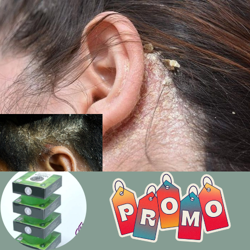 Jual Obat Dermatitis Perioral, Obat Dermatitis Seboroik, Obat Dermatitis Kontak, Cradle Cap ...