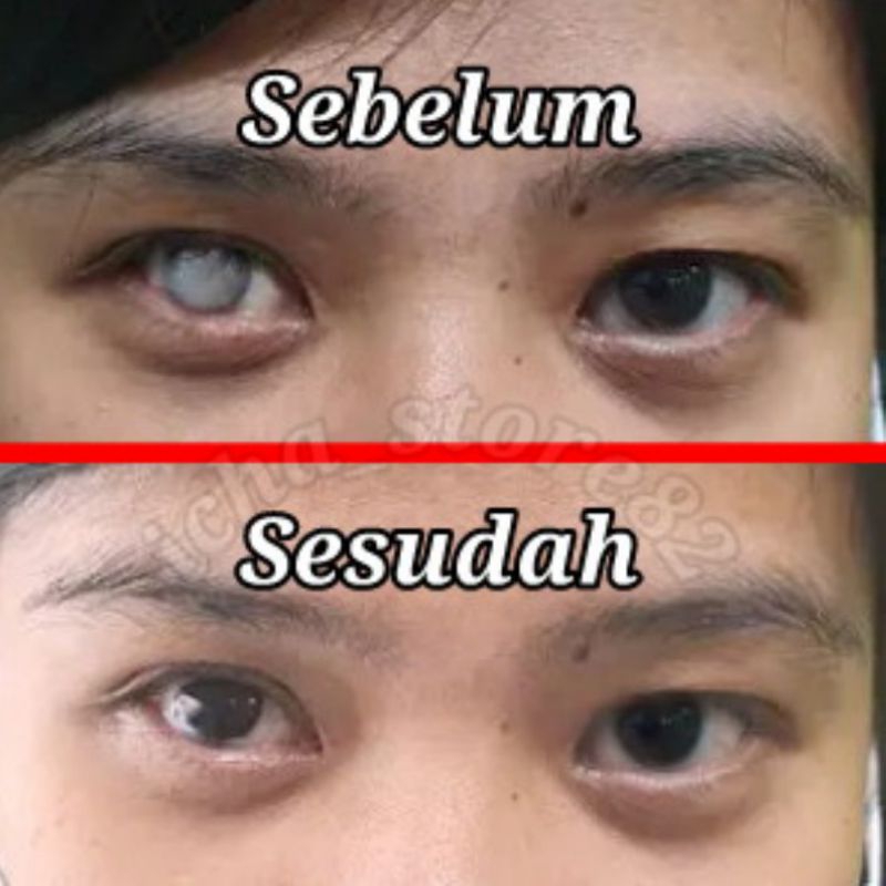 Jual Lensa mata cacat Softlens prosthetic iris Lensa mata cacat ...