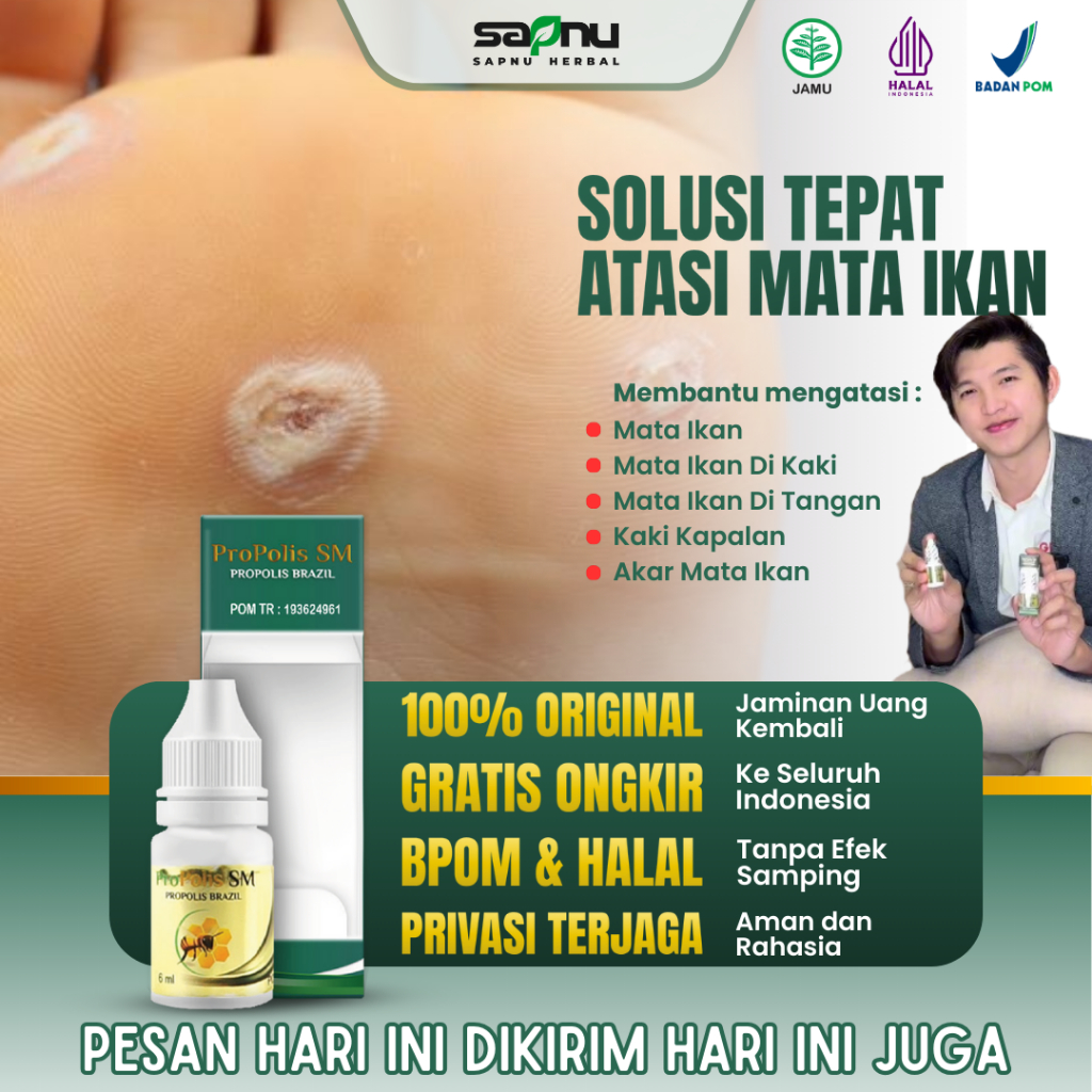 Jual Propolis SM Obat Mata Ikan Pada Telapak Kaki, Obat Penghilang Mata ...