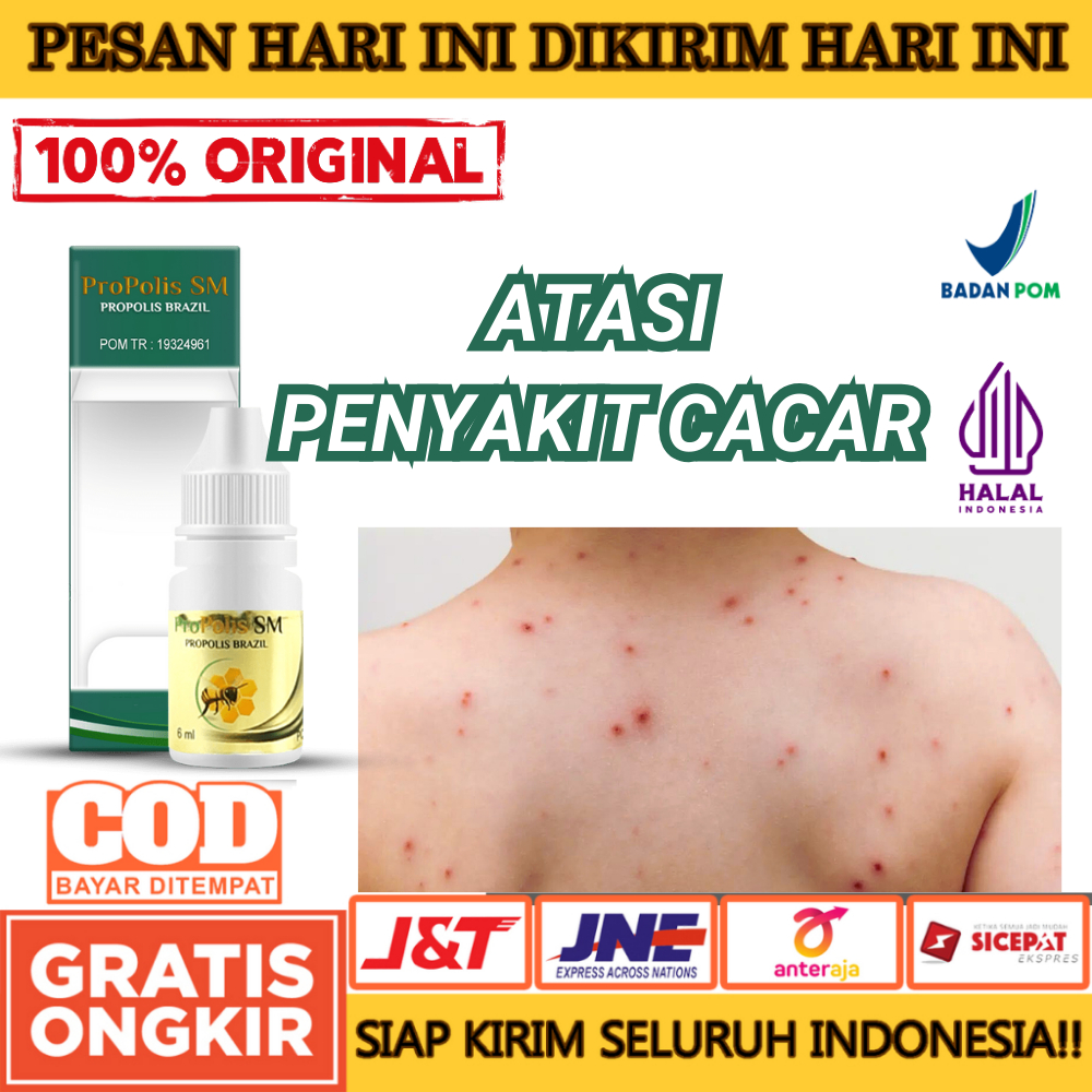 Jual Obat Cacar Air, Cacar Api, Herpes Zoster (Cacar Ular) ,Penghilang ...