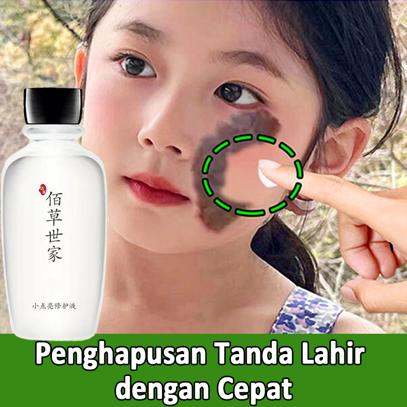 Jual Obat Penghilang Tanda Lahir Coklat Di Wajah Memudarkan Tanda Lahir ...