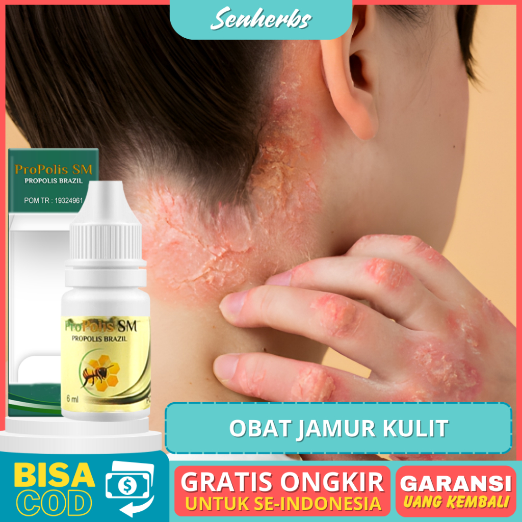 Jual Propolis Sm Obat Jamur Kulit Gatal Gatel Herpes Jamur Di Kepala ...