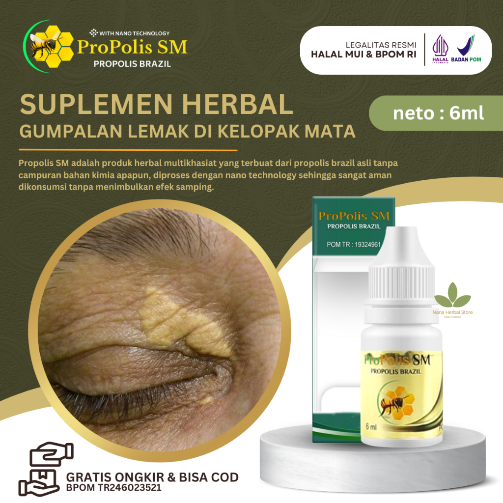 Jual Propolis SM Obat Xanthelasma Penghilang Gumpalan Lemak Di Kelopak ...