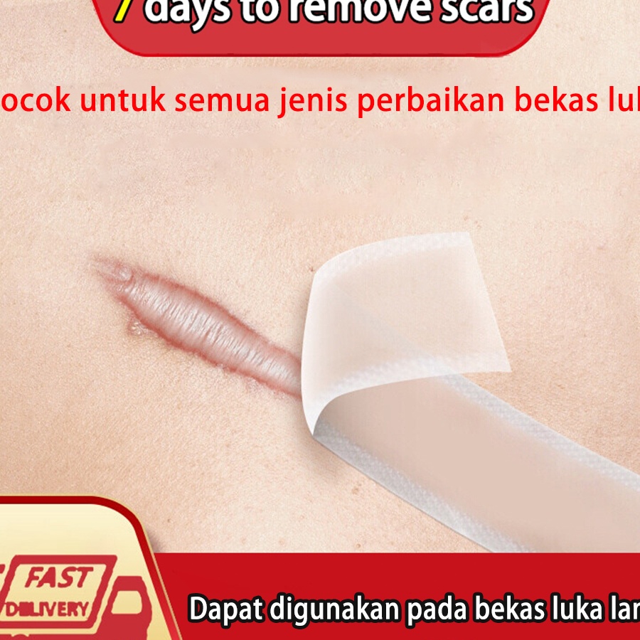 Jual KF7 plester keloid silicone scar sheet Plester Bekas Luka ...