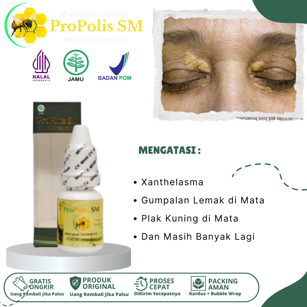 Jual Obat Xanthelasma, Penghilang Gumpalan Lemak di Mata Dengan ...