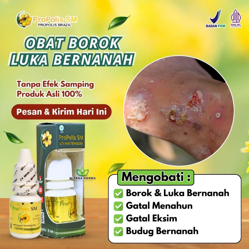 Jual Obat Borok, Obat Luka Bernanah, Obat Gatal Menahun, Obat Gatal ...