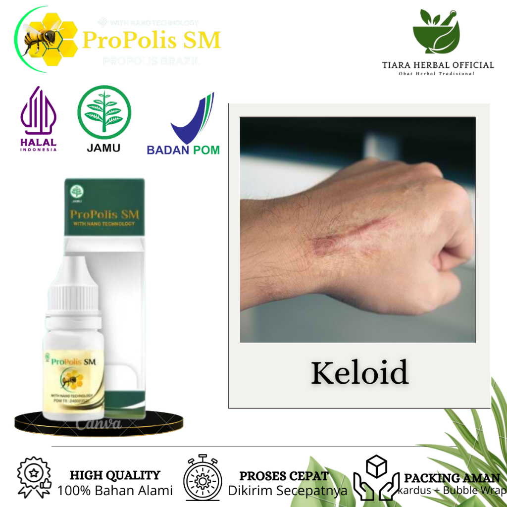 Jual ProPolis SM - Obat Keloid, Daging Tumbuh, Penghilang Daging Tumbuh Bekas Operasi, Benjolan ...