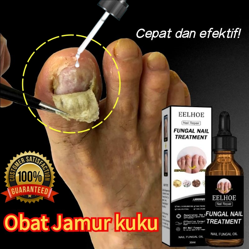 Jual Obat Jamur Kuku Obat kuku jamur dan rusak Anti Jamur Nail Care ...