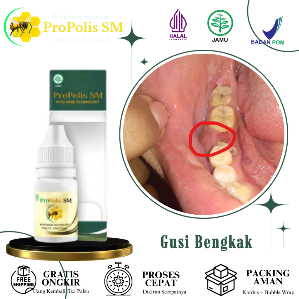 Jual ProPolis SM - Obat Gusi Bengkak Tampak Menonjol Keluar, Gusi ...