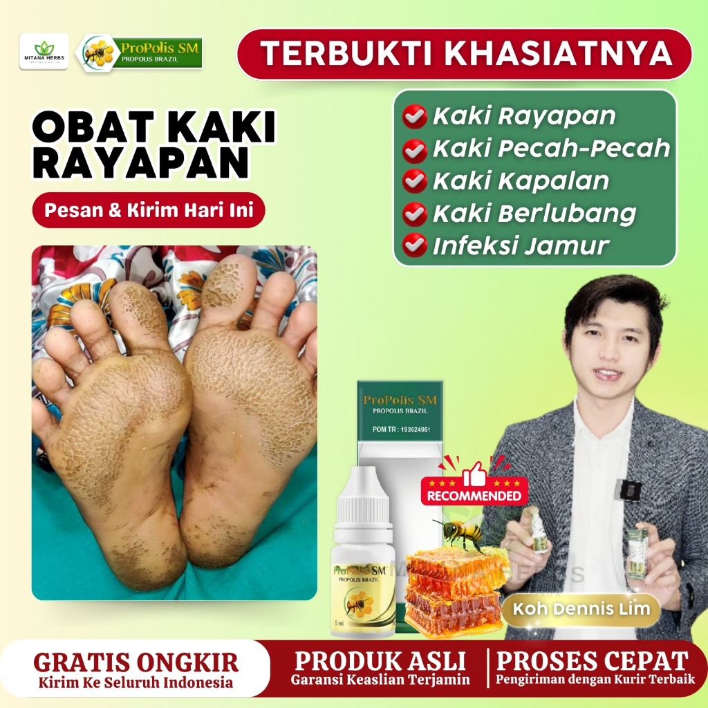 Jual Obat Kaki Rayapan, Obat Kaki Kapalan, Obat Kaki Berlubang, Obat ...