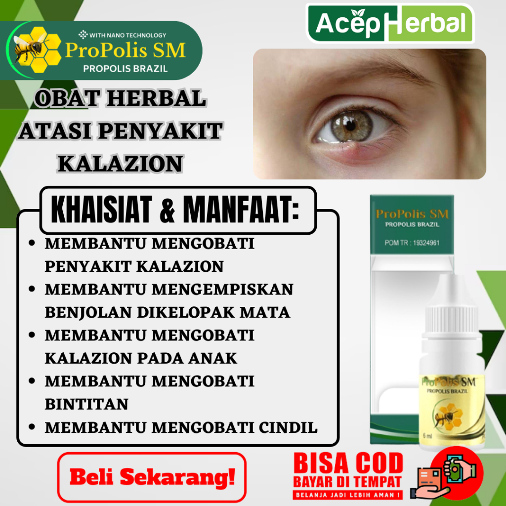 Jual Obat Kalazion - MENGEMPESKAN BENJOLAN DI KELOPAK MATA - Obat ...