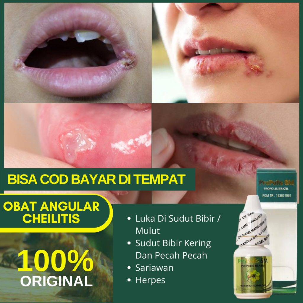 Jual Obat Luka Di Sudut Bibir / Mulut, Angular Cheilitis, Sudut Bibir ...