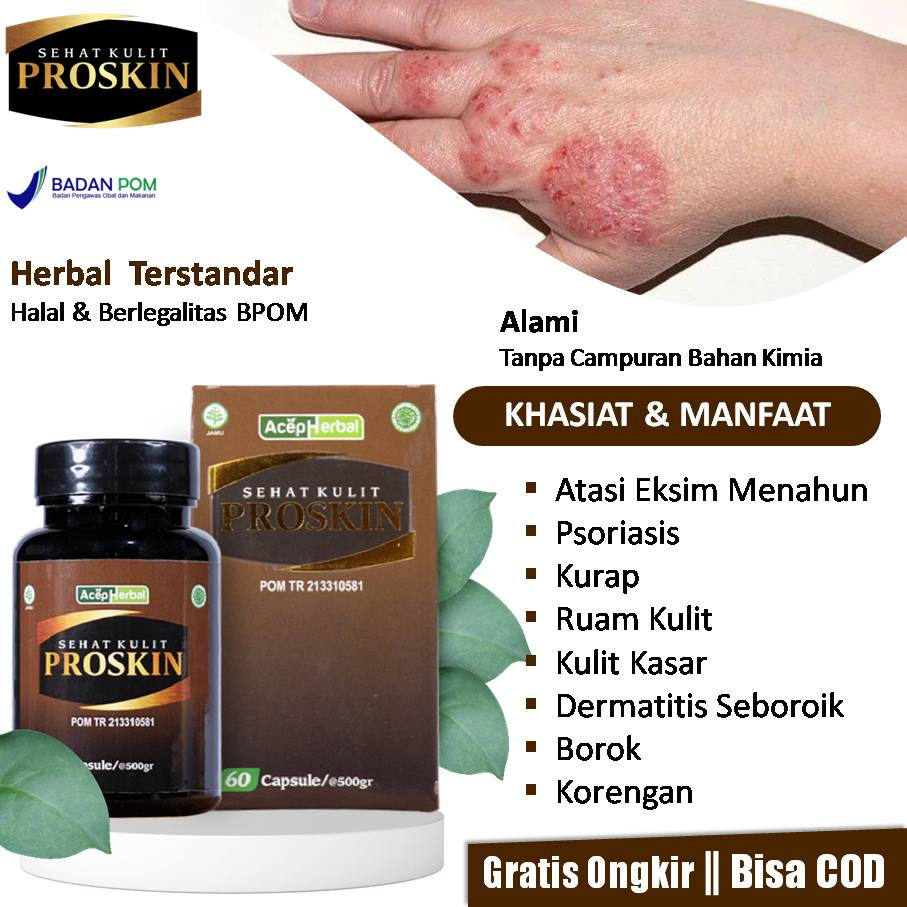 Jual Obat Eksim Menahun, Psoriasis, Kurap, Ruam Kulit, Kulit Kasar Dan ...