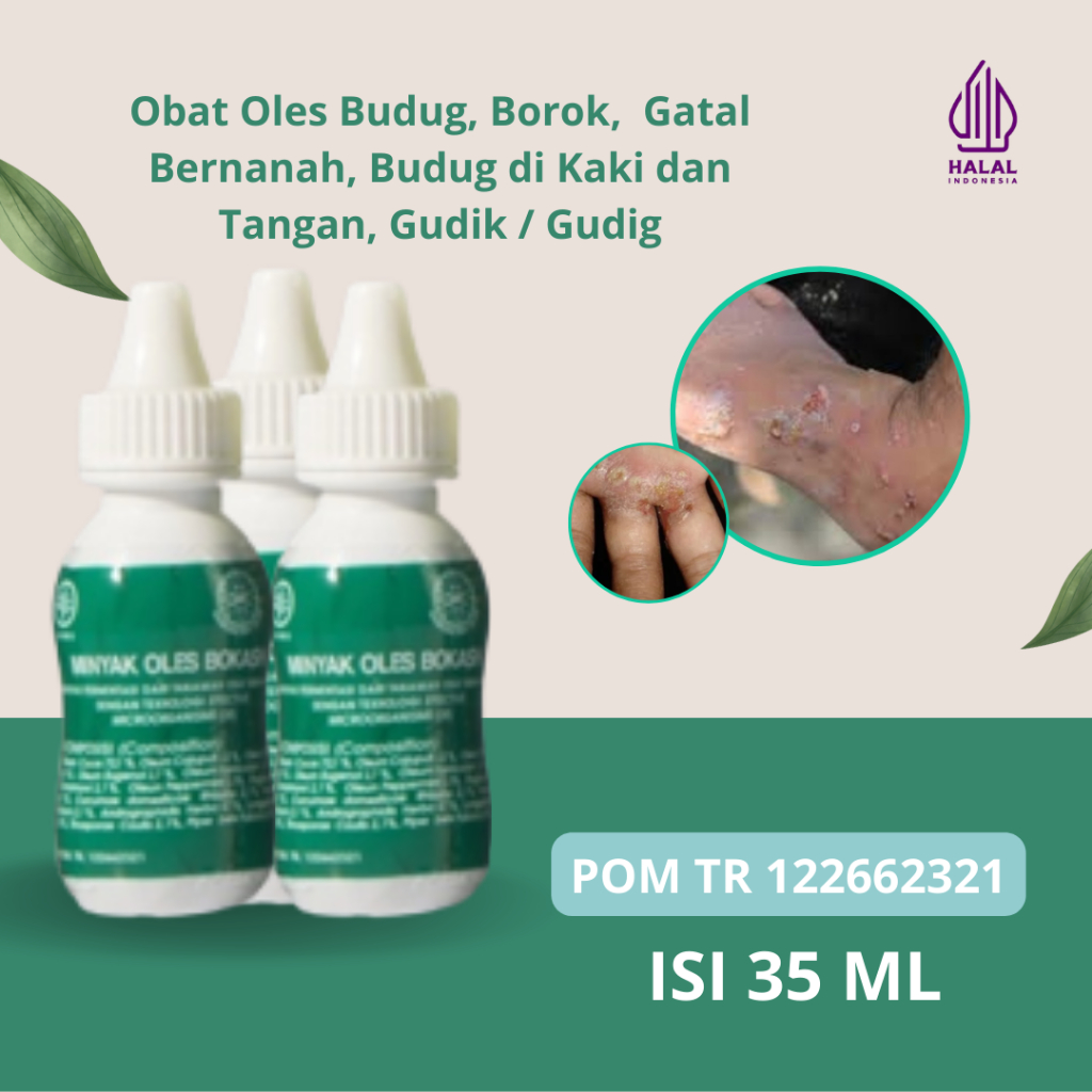 Jual OBAT OLES BUDUG, BOROK, GATAL BERNANAH, BUDUK DI KAKI DAN TANGAN ...