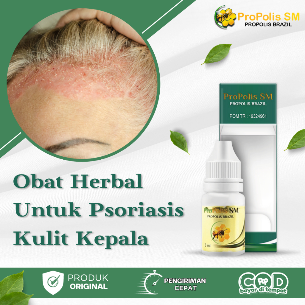 Jual Obat Psoriasis Kulit Kepala, Jamur Kulit Kepala, Kulit Kepala Bersisik, Infeksi Jamur di ...