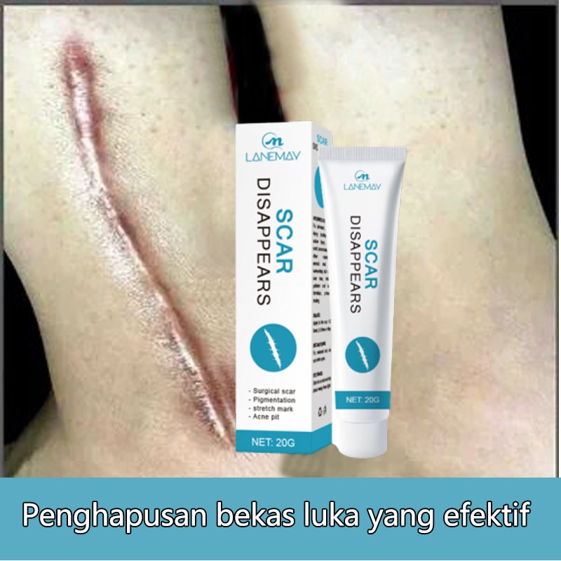 Jual Salep Penghilang Bekas Luka Hitam Penghilang Bekas Luka Cream Penghilang Bekas Luka 20g