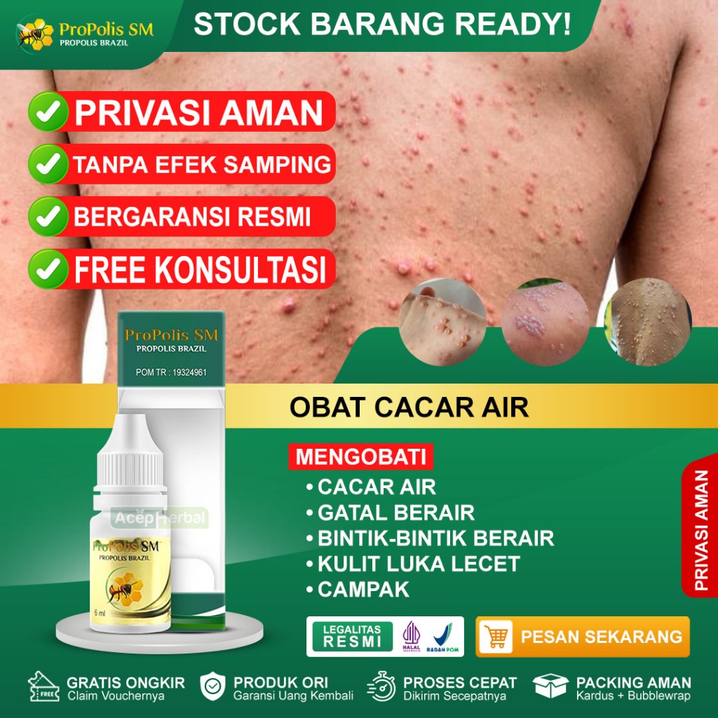 Jual Obat Cacar Air Gatal-gatal Berair Bintik-bintik Berair Kulit Luka ...