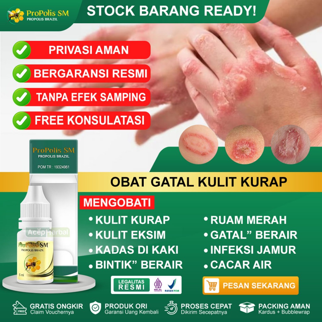 Jual Obat Gatal Kulit Kurap Kulit Eksim Basah/Kering Kadas Di Kaki ...