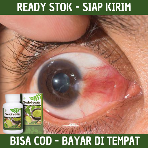 Jual Obat Mata Berlemak, Pterygium, Mata Berlemak Kekuningan, Penghilang Lemak di Mata ...