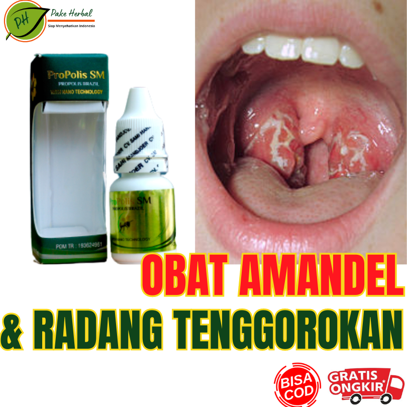 Jual Obat Amandel Radang Tenggorokan Pengempis Amandel Obat Sariawan Amandel Gondok Amandel ...