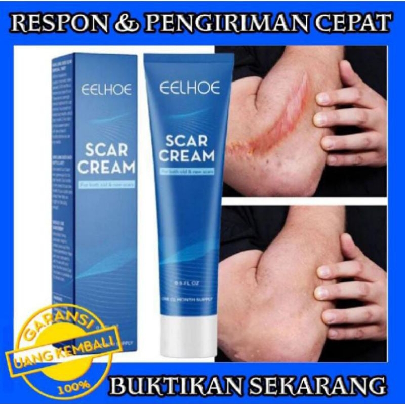Jual Stretch Marks Remove Acne Spots Surgical Scars Penghilang Bekas ...