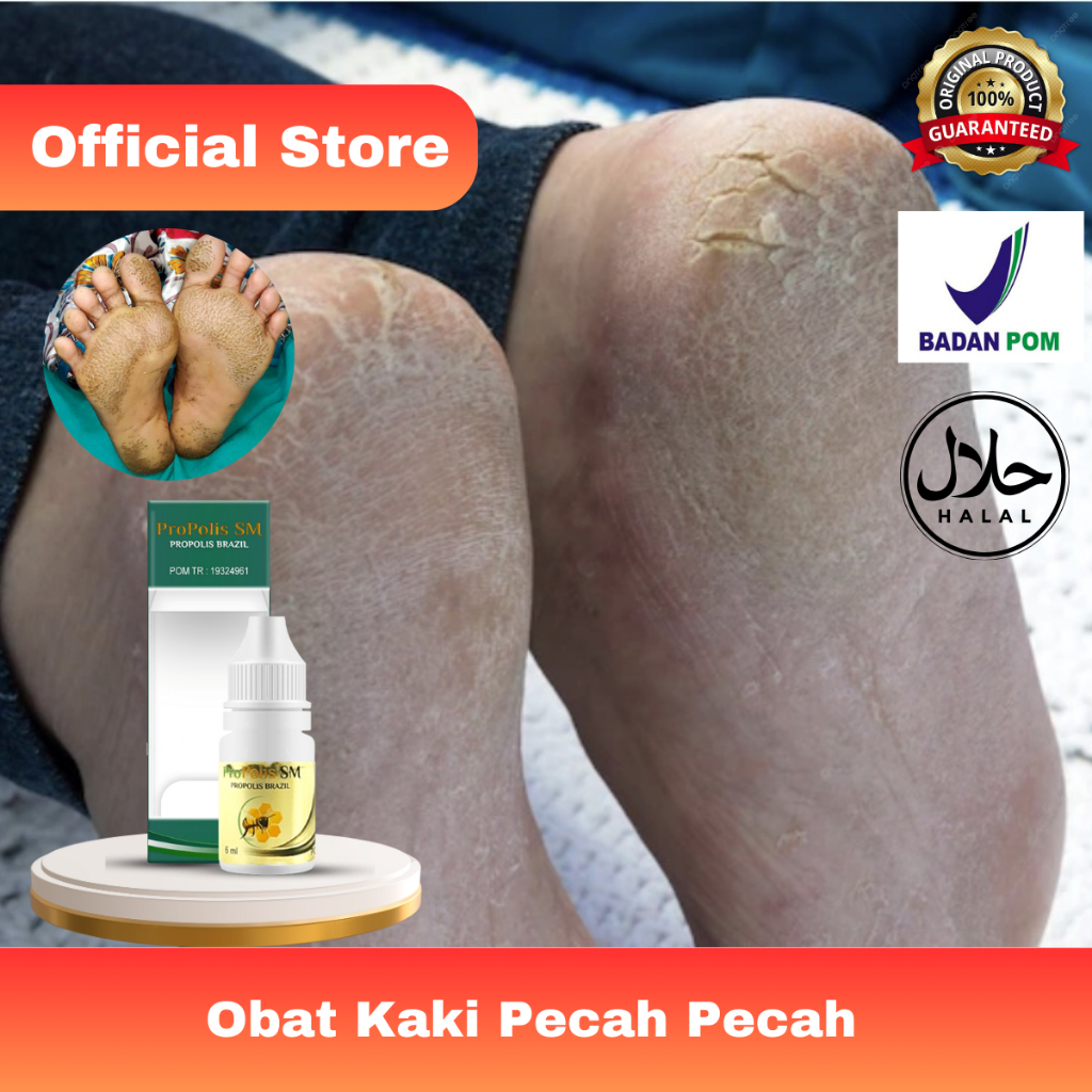 Jual Obat Kaki Pecah Pecah, Kaki Rayapan, Obat Kaki Kapalan, Obat Kaki ...