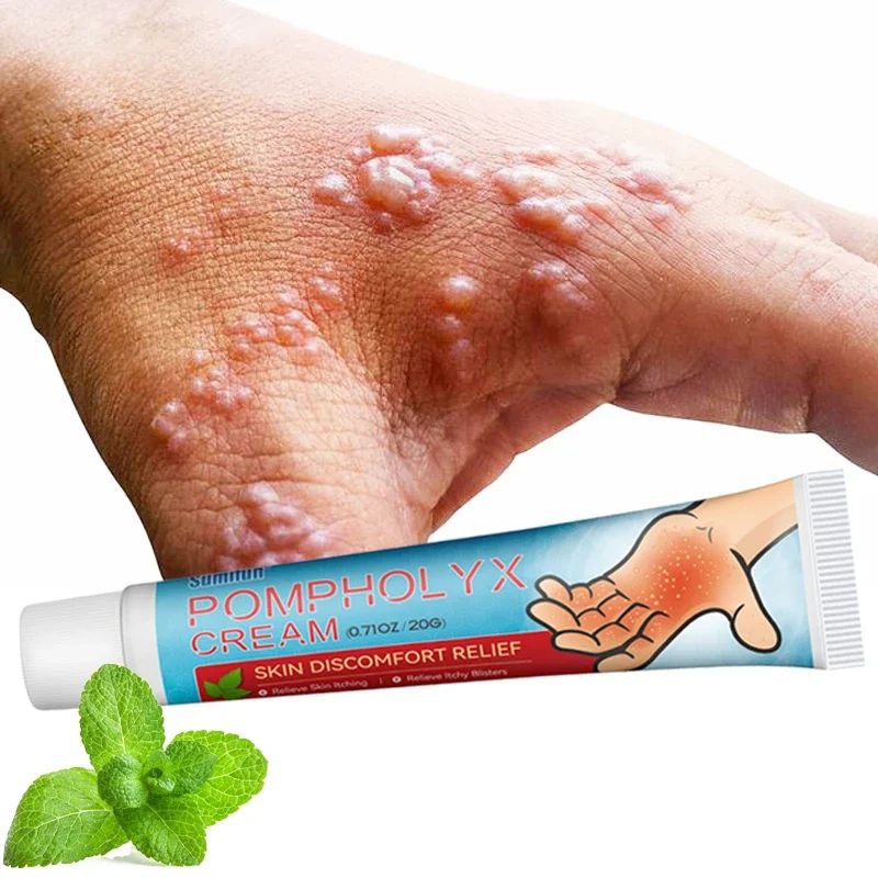 Jual salep gatal bintil air kutu air pompholyx dermatitis atopik eksim ...