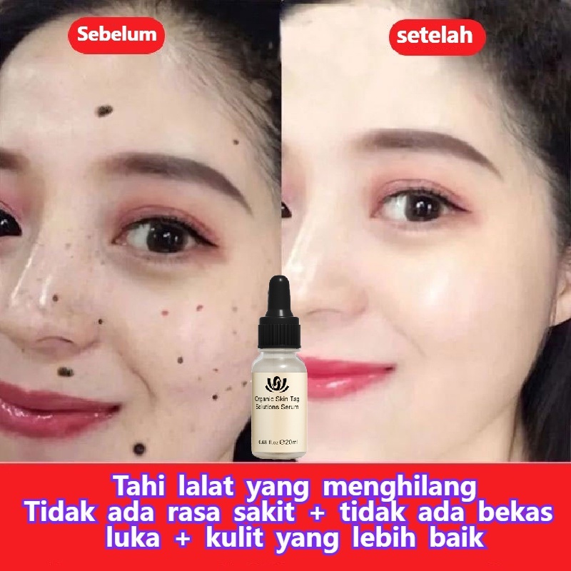 Jual Wart Removal Serum Penghilang Penghilang tahi lalat Perbaikan Flek ...