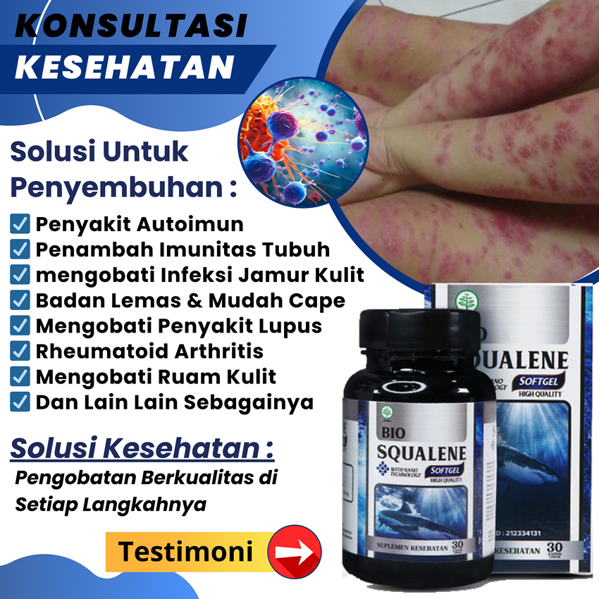 Jual Obat Autoimun Penambah Imun Tubuh Ruam Merah Penyakit Kulit Lupus ...