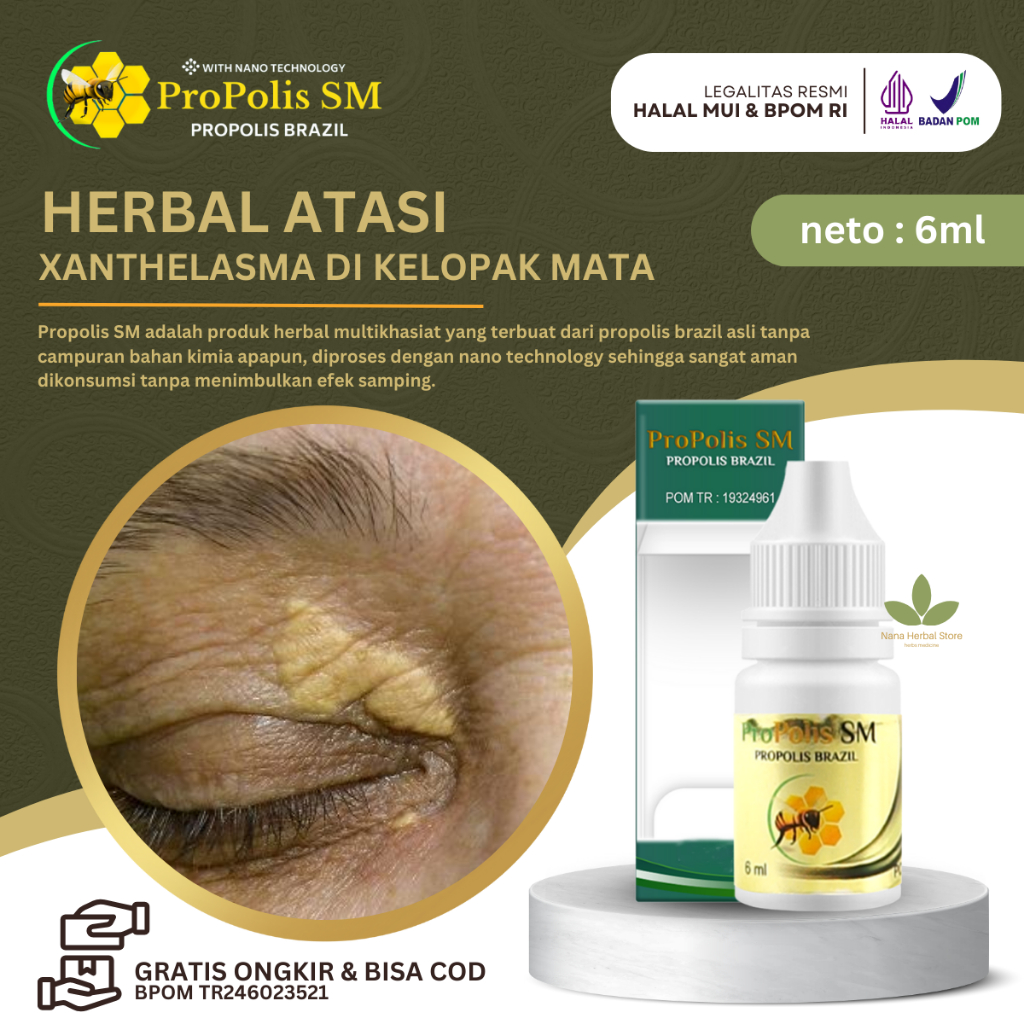 Jual Propolis SM 6ml Obat Xanthelasma Gumpalan Lemak Di Kelopak Mata ...
