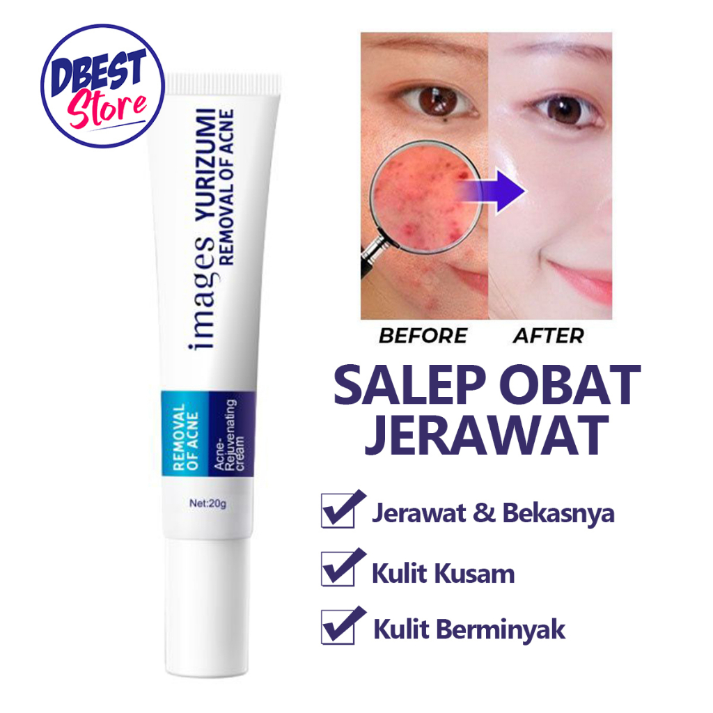 Jual YURIZUMI Obat Jerawat Paling Ampuh Cewek / Acne Removal Cream Acne ...