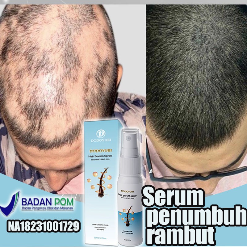 Jual (BPOM)Serum penumbuh rambut Obat penumbuh rambut botak pria ...