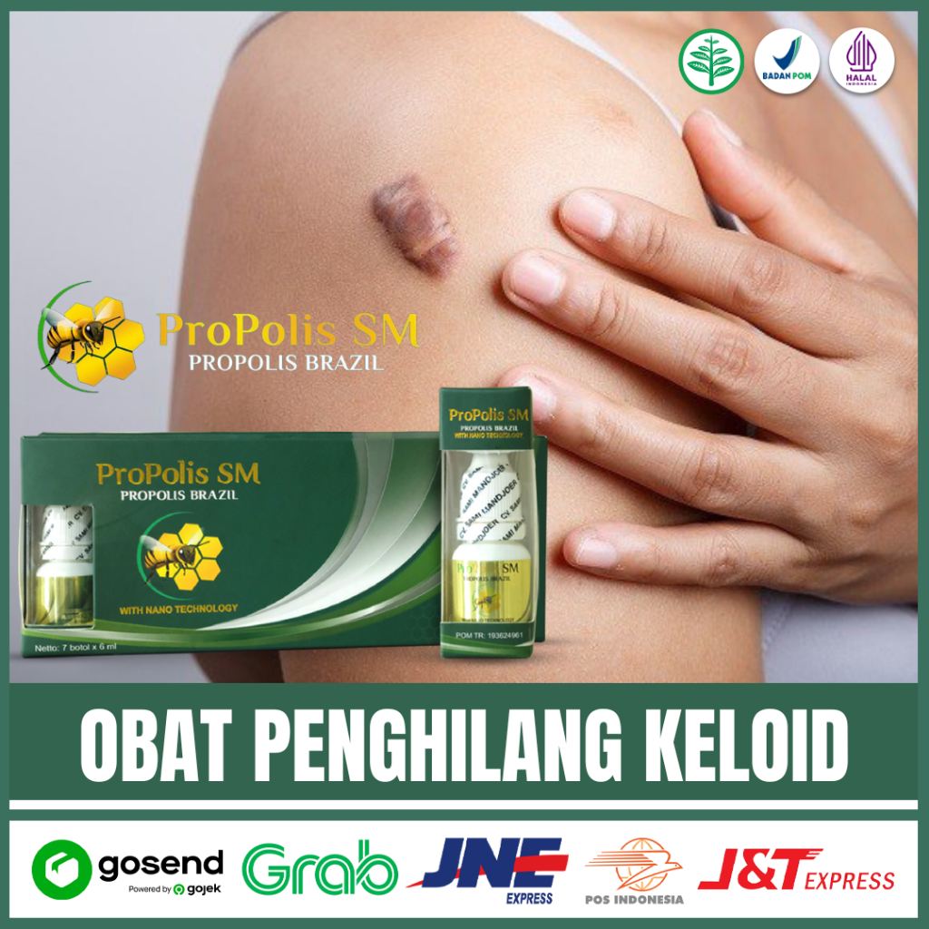 Jual Obat Penghilang Keloid,Keloid Bekas Luka,Obat Keloid Bekas Operasi Daging Tumbuh Propolis ...