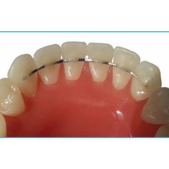 Jual KF7 Alice dental Lingual retainer fix retainer FDA kawat gigi ...