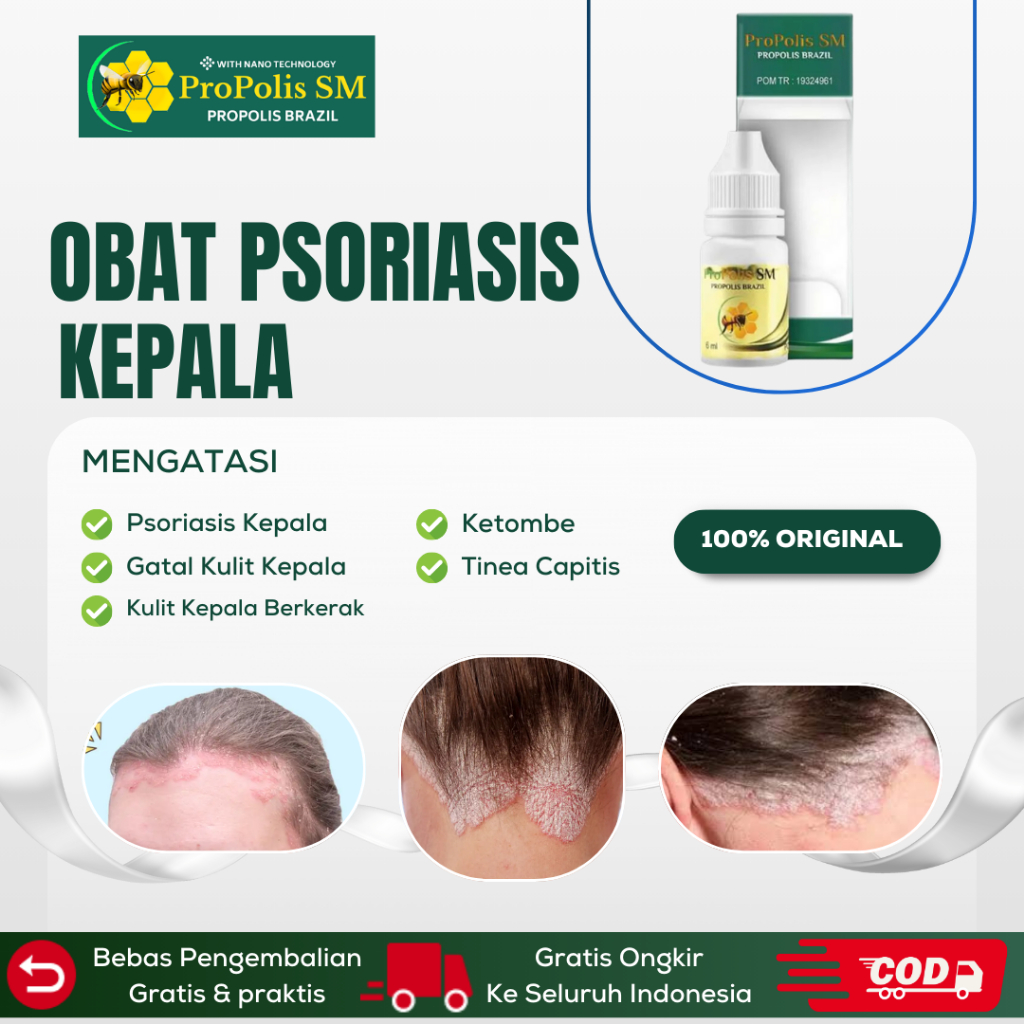 Jual Obat Psoriasis Kulit Kepala Berkerak Kulit Kepala Bersisik Gatal ...