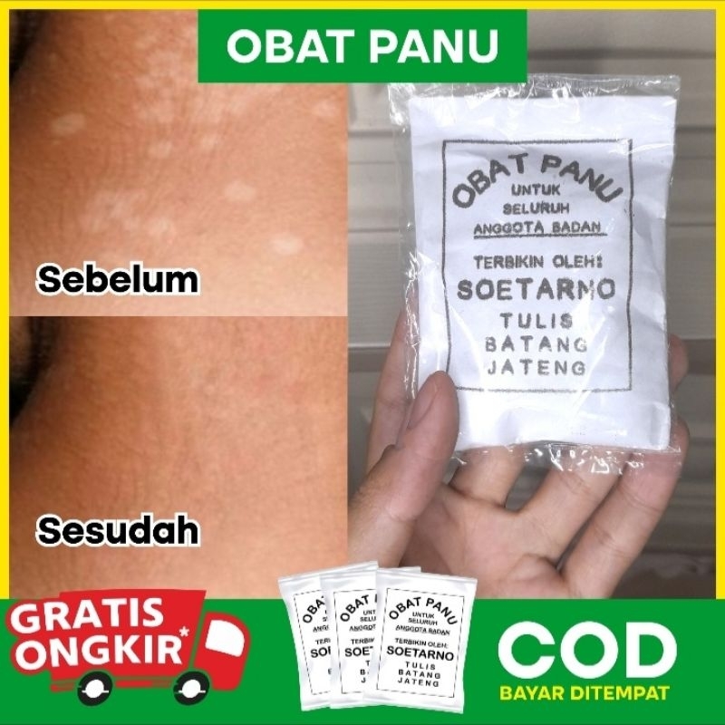 Jual Obat panu paling ampuh 100% / Obat panu tablet / Sabun panu paling ...
