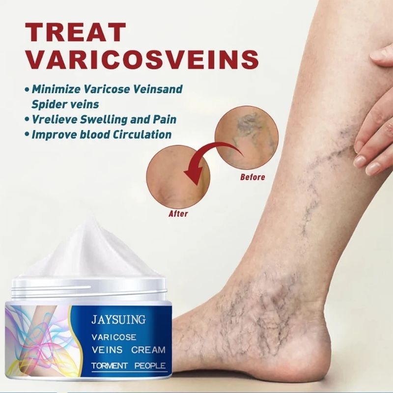 Jual Cream Varises Vena Kaki Atasi Bengkak Pembuluh Darah Kaki ...