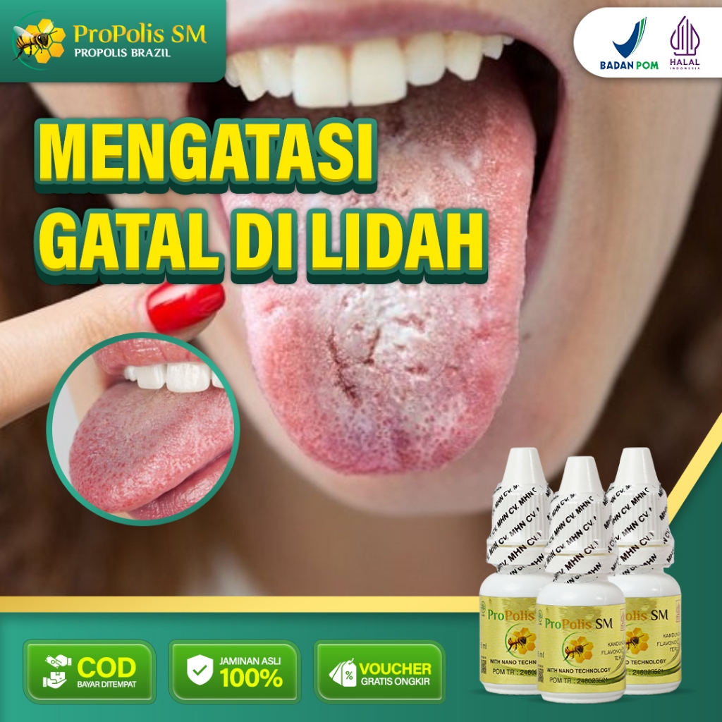 Jual obat gatal lidah propolis sm,obat lidah gatal,Lidah Berjamur ...