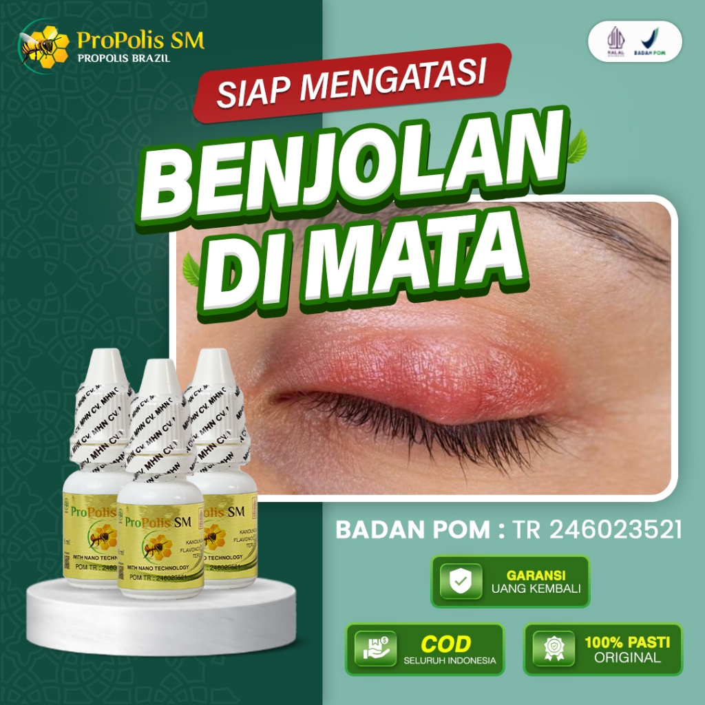 Jual Obat Benjolan Di Kelopak Mata Obat Mata Bintitan Bintilan Benjolan ...