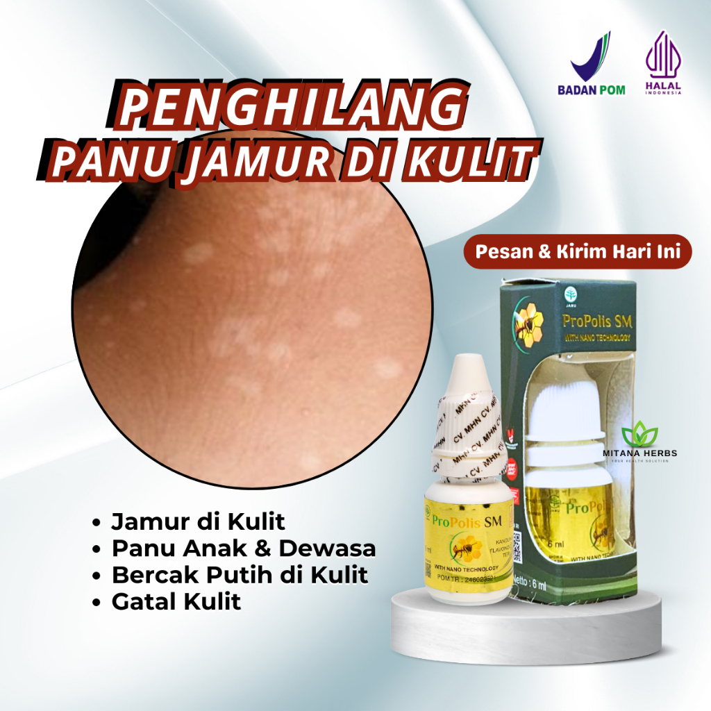 Jual Obat Hapur Kulit, Obat Panu, Obat Jamur Kulit, Obat Panu Cair ...