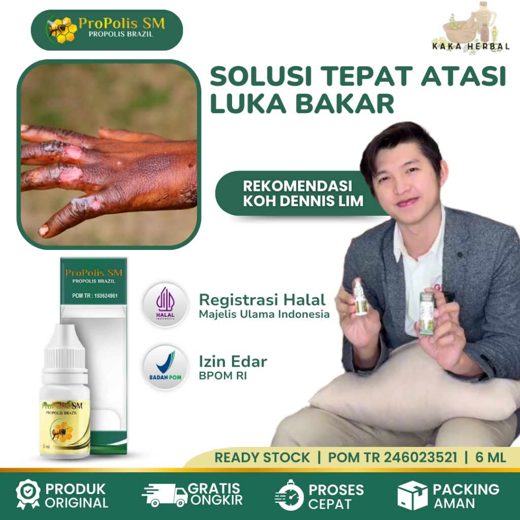 Jual Kaka Herbal - Obat Pengering Luka Bakar, Obat Oles Luka Bakar ...